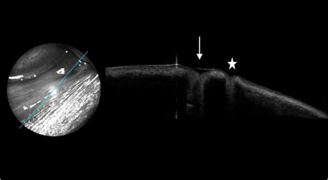 Supernumerary Puncta An Uncommon Underdiagnosed Cause Of Unilateral Epiphora Published In Cro