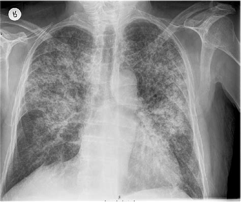 Diffuse Bilateral Perihilar Inhomogenous Infiltrates On Chest X Ray