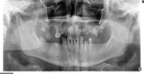 Pathology Outlines Peripheral Ossifying Fibroma