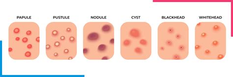 How To Prevent And Treat Acne Understanding The Causes And Effective Treatments