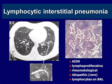 Ipf Or Non Ipf Interstitial Lung Diseases Pdf
