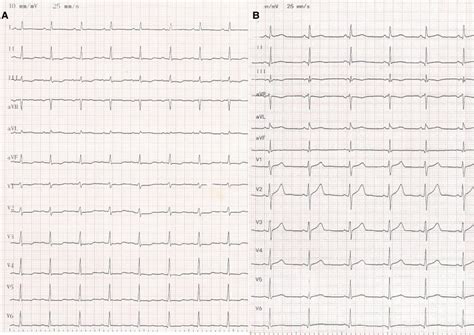 Ultra Early Myocardial Calcification Secondary To Fulminant Myocarditis With 4 Years Of Follow