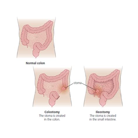 Loop Colostomy Reversal