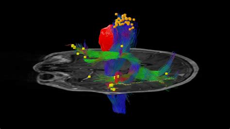 Nexstim Ntms And Brainlab Elements Brainlab