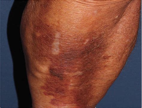 Successful Treatment Of Chronic Venous Stasis Hyperpigmentat
