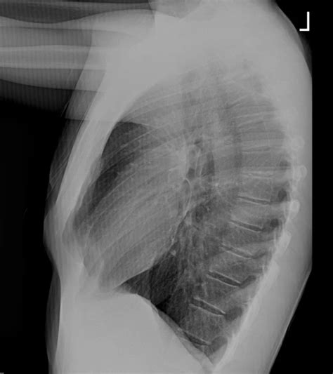 A 45 Year Old With Chest Deformity Journal Of Urgent Care Medicine