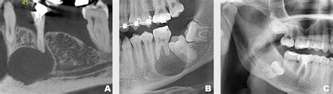 Radiographic Features Of Odontogenic Cyst Lined By A Non Keratinized