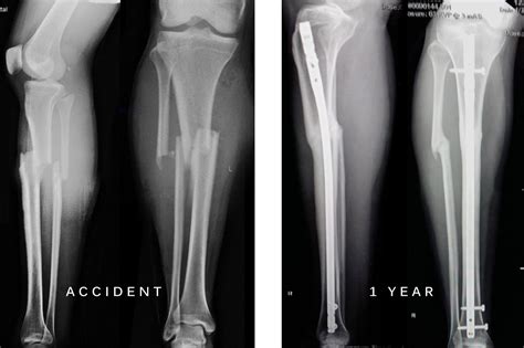 UPDATE 1 Year Later Tib Fib Compound Fracture R Brokenbones