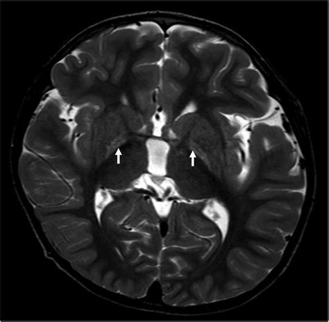 Kernicterus Pattern On Axial T Weighted Imaging With Symmetric Download Scientific Diagram