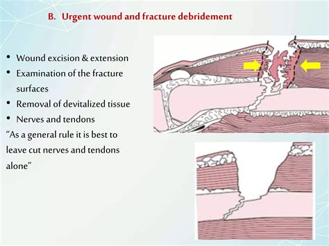 Principles Of Fractures Management Pptx