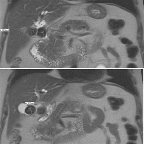 Intraoperative Cholangiography Showing No Stenosis Of The Common Bile Download Scientific