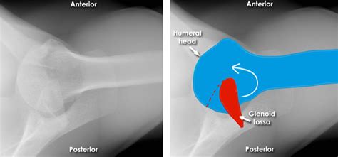 Shoulder Dislocation