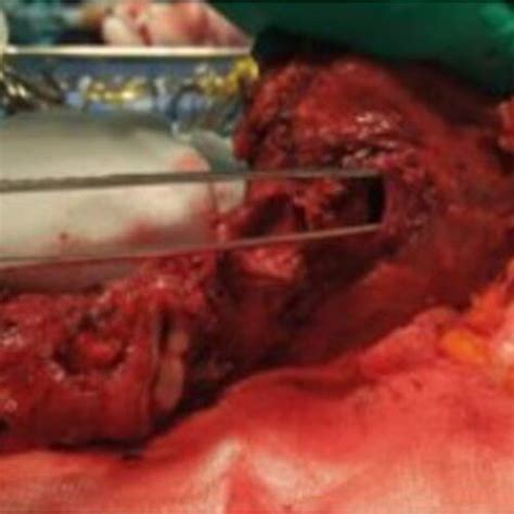 Specimen From Another Perspective Requiring Radical Cystectomy