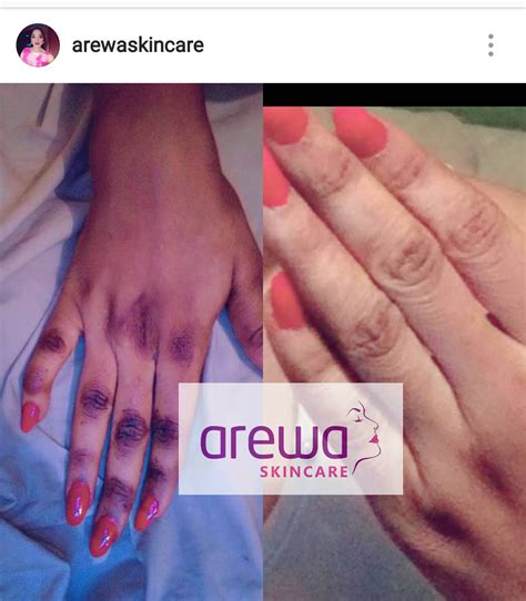 How To Get Rid Of Dark Knuckles