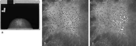 A Mammogram R21tif From Bezanijska Kosa And Segmented