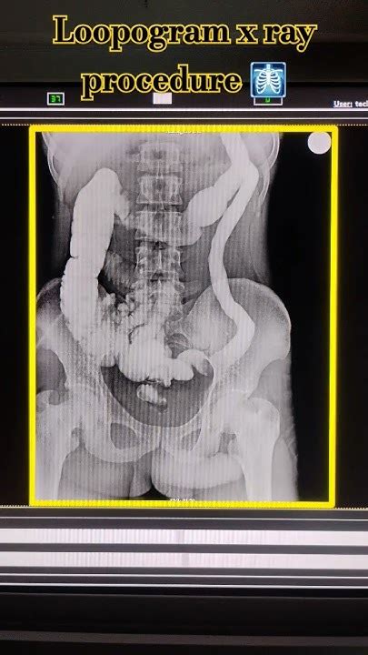Loopogram X Rayloopogramxray Xray Xrayprocedure Youtube
