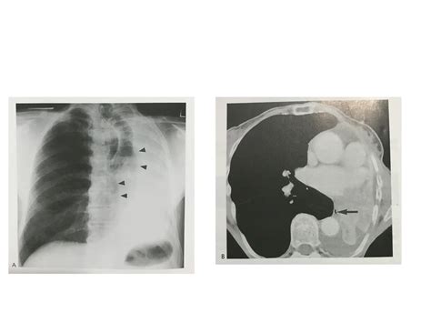 Collapse And Consolidation Pathology And Radiology Pptx