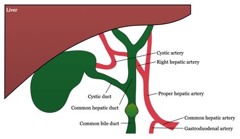 Choledocholithiasis Surgery Student