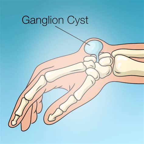 Common Hand Disorders Hand Wrist And Elbow Doctor Articles Asia