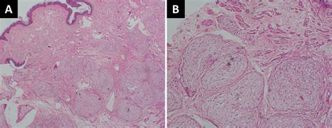 Plexiform Neurofibroma Histopathology