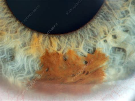 Iris Nevus Stock Image C0272228 Science Photo Library