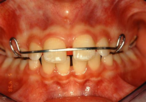 Orthodontic Appliances Removable