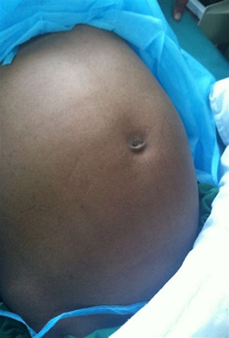 Giant Hydronephrosis Presented As A Huge Abdominal Mass In A 16 Year