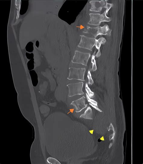 Unusual Case Of Plasma Cell Neoplasm Masquerading As A Sacral Mass In A 51 Year Old Male Shm