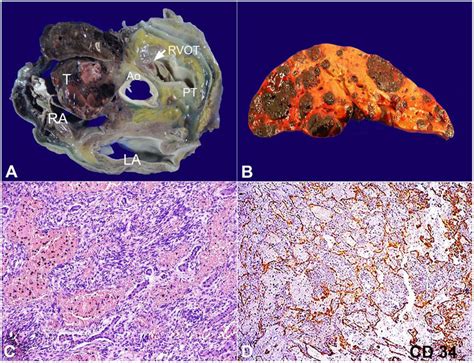 A Gross View Of The Right Atrial Angiosarcoma B Macroscopic Appearance