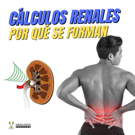 Microlitiasis Renal Urología Peruana Dr Susaníbar