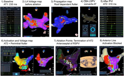 Atrial Fibrillation And Left Atrial Flutter Ablation Guided By Download Scientific Diagram