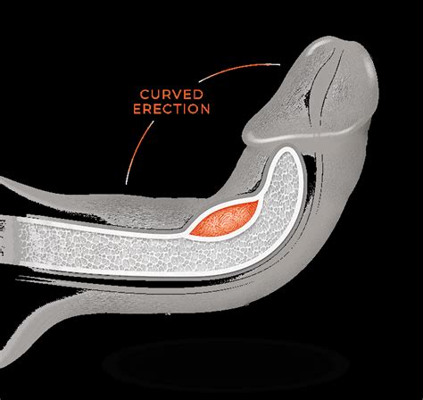 Treatpeyronies