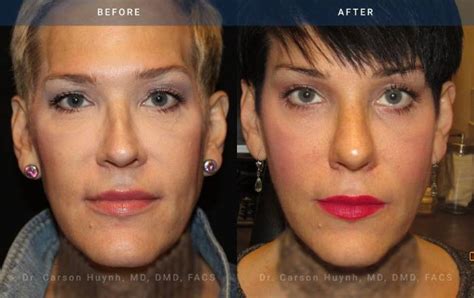 V Line Jawline Surgery Case 2161 Radiance Surgery And Aesthetic Medicine