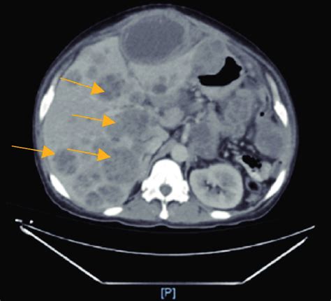 Computed Tomography Ct Scan Showing Multiple Necrotic Liver Download Scientific Diagram