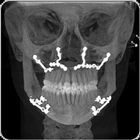 Condylar Hypoplasia 1 Movahed Oms