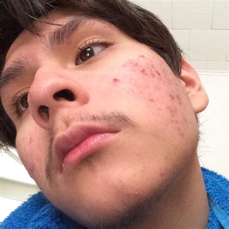 Excessive Masturbation While On Accutane Hyperpigmentation Reddark