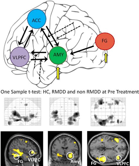 Figure 1 From Fronto Limbic Effective Connectivity As Possible Predictor Of Antidepressant