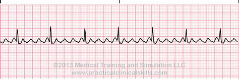 Atrial Flutter Ekg Interpretation With Rhythm Strip