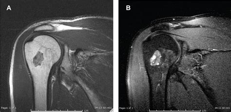 Evaluation Of The Patterns Of Benign Bone Tumors And Tumor Like Lesions