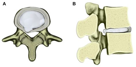 Schematic Diagram Of Contained Herniated Lumbar Disc With Transverse