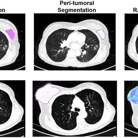 Examples Of Segmentations In Tumoral And Peri Tumoral Radiomics And The