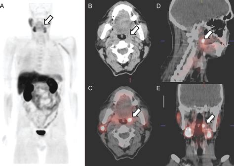 Squamous Cell Carcinoma Of The Tonsil Incidentally Detected