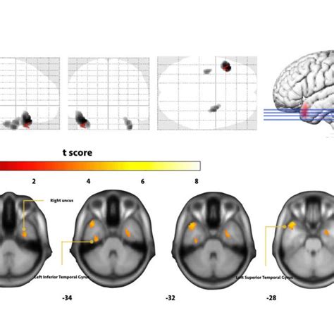 voxel based morphometry analysis between pd group and nc group a