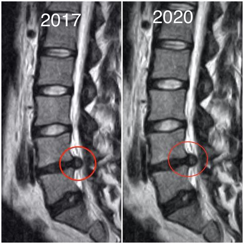 Discectomy Before And After