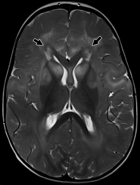 Macrocephaly Mri