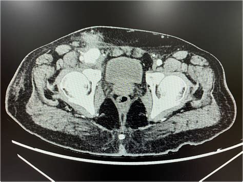 Tctap C 147 An Interesting Case Report Delayed Presentation Of