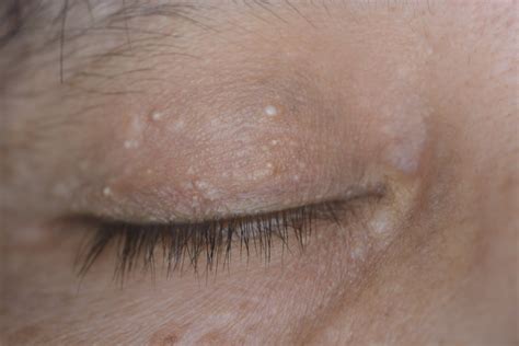 What To Do If You Have A Bump On Your Eyelid That Is Not A Stye Eye