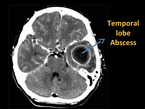 Otogenic Brain Abscesspptx