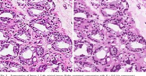Figure 3 From Automatic Segmentation Of Molecular Pathology Images Using A Robust Mixture Model