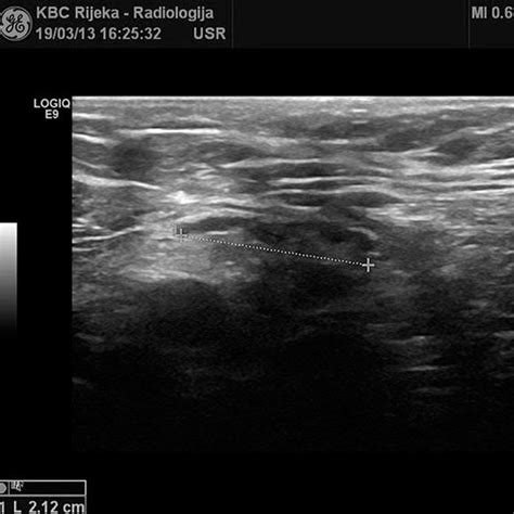 Ultrasound Image Of Reactive Axillary Lymph Node Download Scientific